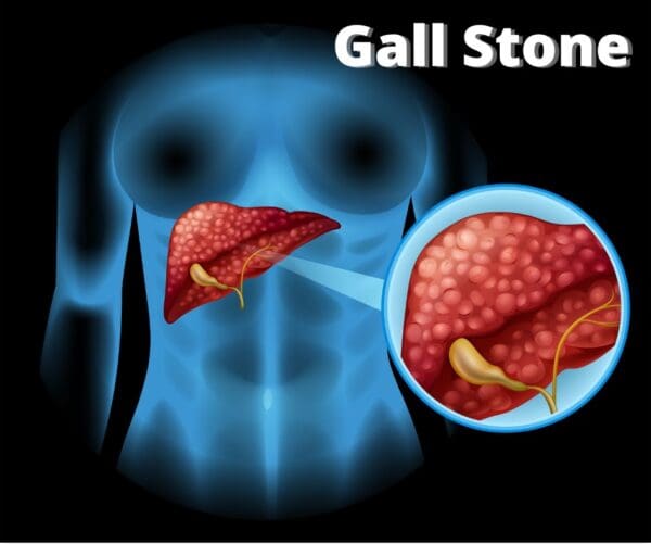 Gall Stone Polyp types, causes, and symptoms | Homeo care clinic