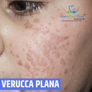 Verruca Plana Removal