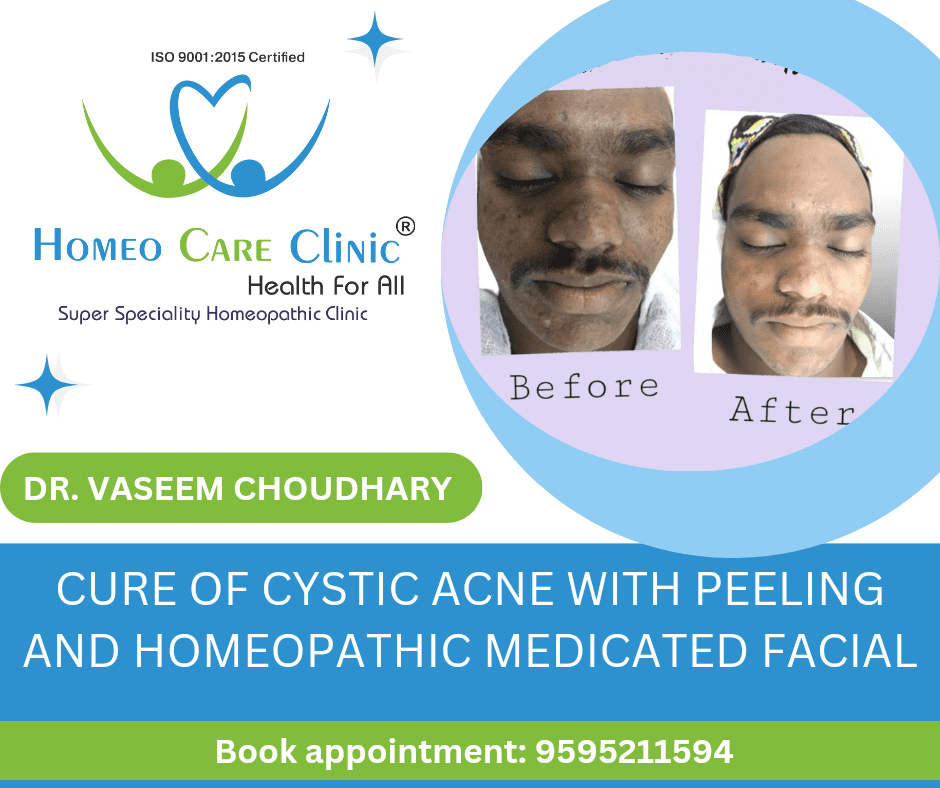 Homeopathic Cure for Cystic Acne with Medicated Facial - Homeo Care ...