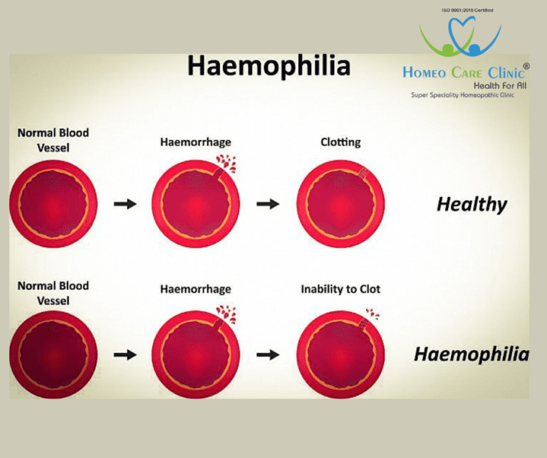 Haemophilia: Causes, Symptoms and Homeopathic Treatment