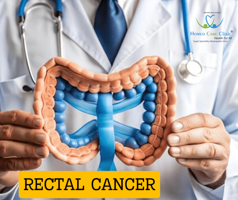 Rectal Cancer: Causes, Symptoms and Homeopathic Treatment