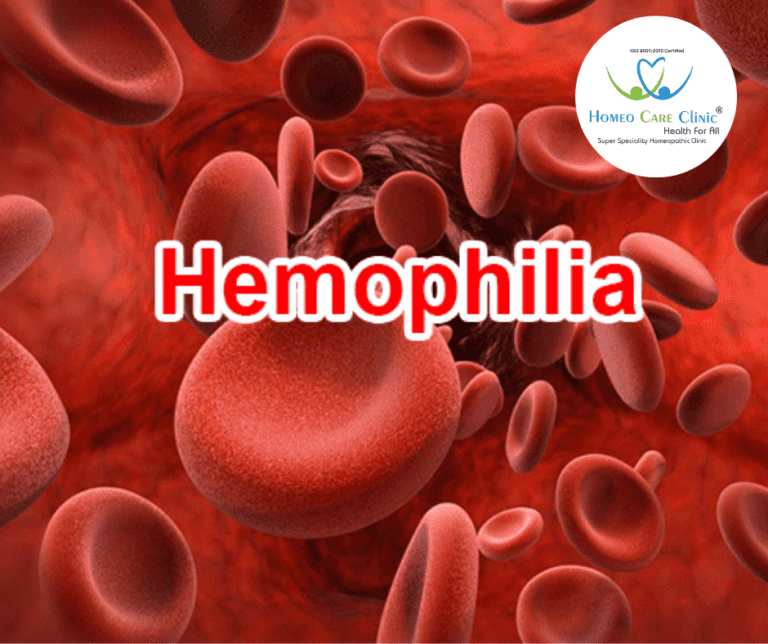 Haemophilia: Causes, Symptoms and Homeopathic Treatment