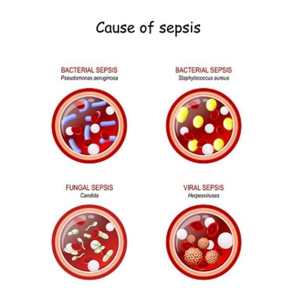 Septicemia: Symptoms, Causes and Homeopathic Treatment
