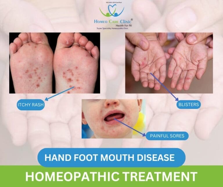Homeopathic Treatment for Hand, Foot, and Mouth Disease - Dr Vaseem