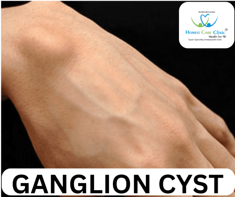 Ganglion Cyst: Causes, Symptoms, & Homeopathy Treatment