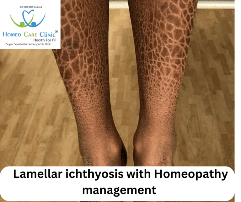 Lamellar Ichthyosis: Causes, Symptoms and Homeopathic Treatment