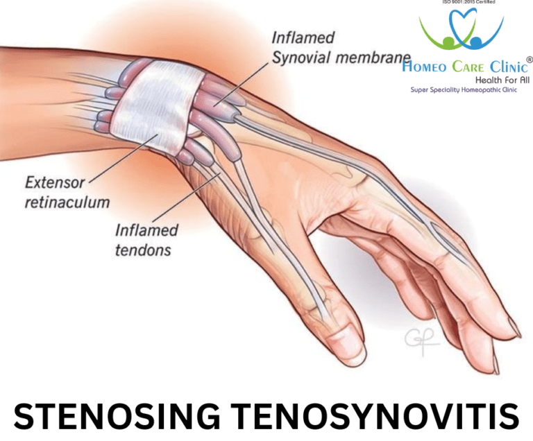Stenosing Tenosynovitis Causes, Symptoms, and Homeopathic Remedies