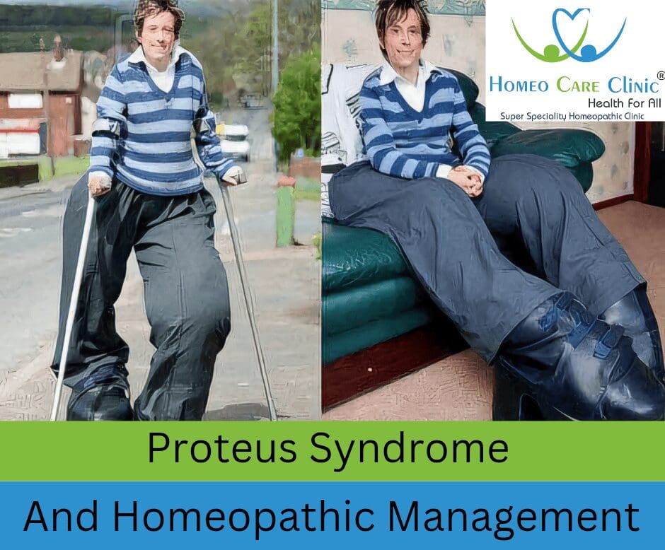 Proteus Syndrome – Causes, Symptoms, & Homeopathy Treatment