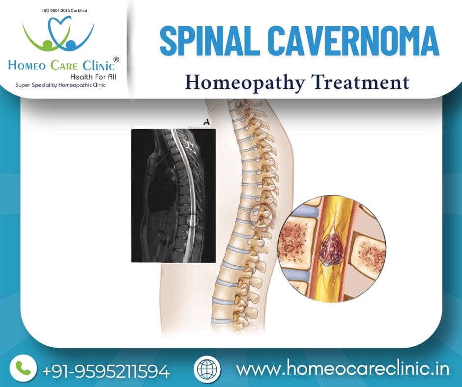 Spinal Cavernoma: Symptoms, Causes & Homeopathic Medicine