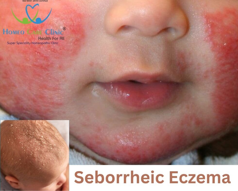 Seborrheic Eczema in Infants: A Gentle Guide for Parents